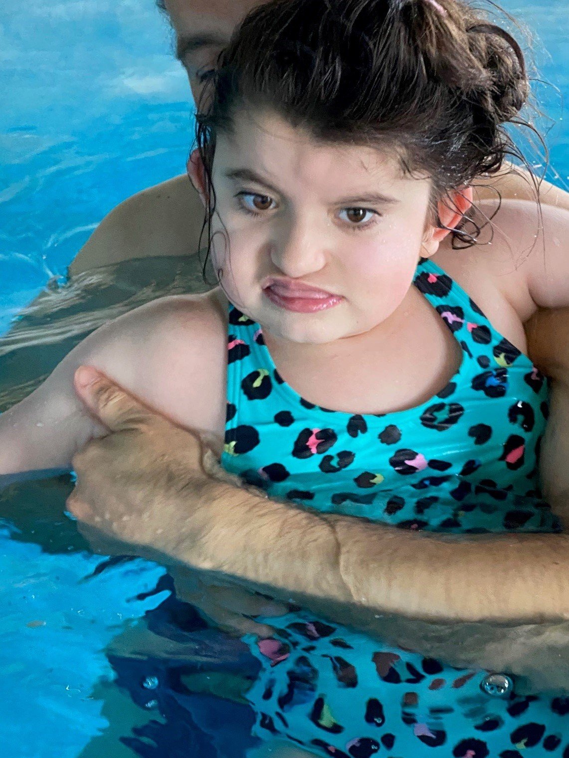 How Schinzel-Giedion Syndrome (SGS) has changed our lives