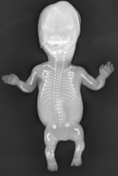 Expanding our understanding of skeletal dysplasia